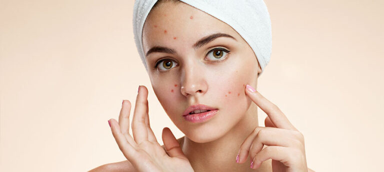 Cold Sore or Pimple? Here's How to Tell the Difference